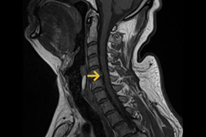 Cervical-/Foramenstenose – Gemeinschaftspraxis für Neurochirurgie