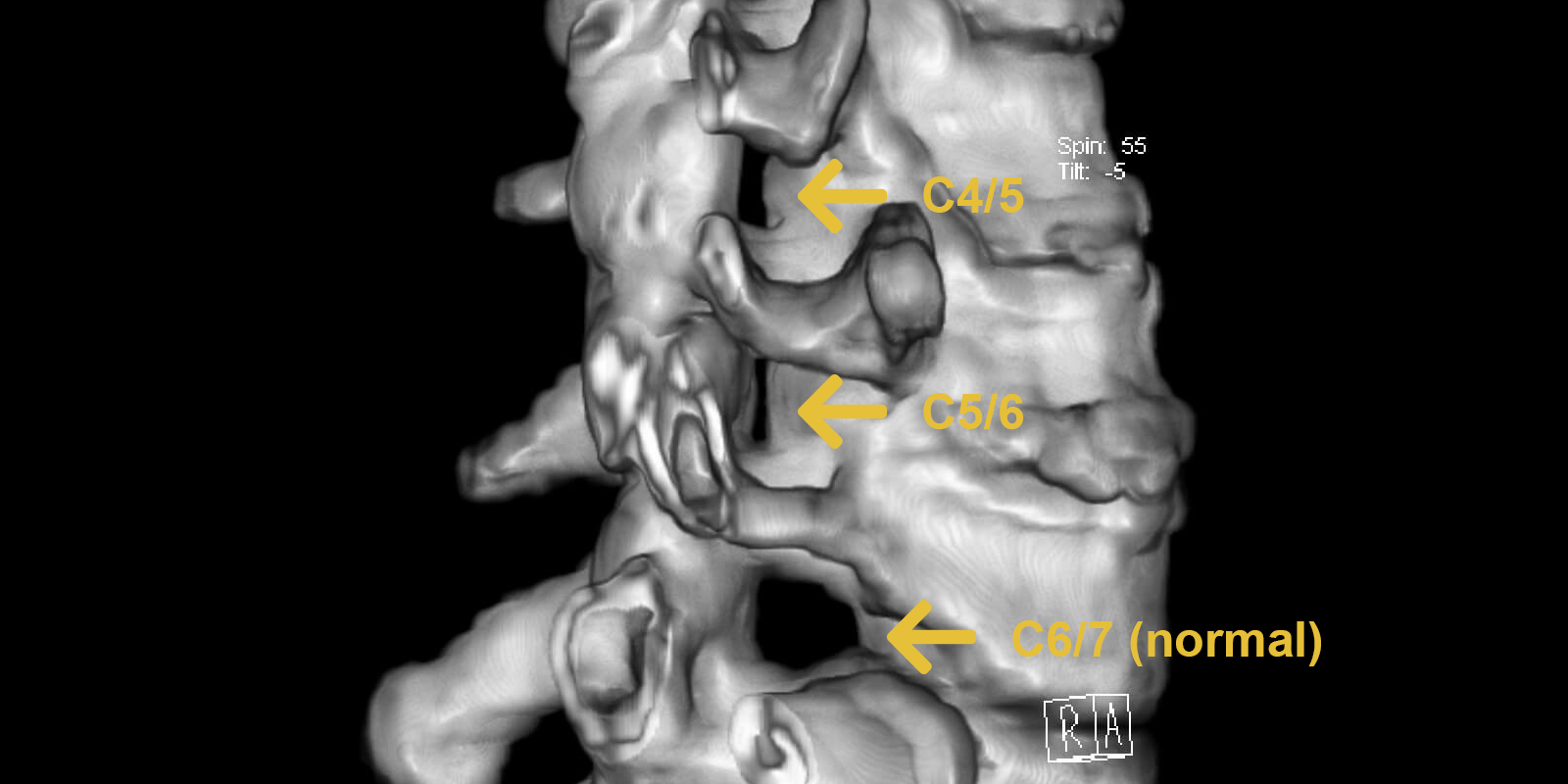 Cervical-/Foramenstenose – Gemeinschaftspraxis für Neurochirurgie