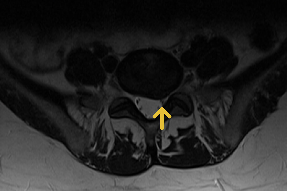 Erosive Osteochondrose – Gemeinschaftspraxis für Neurochirurgie
